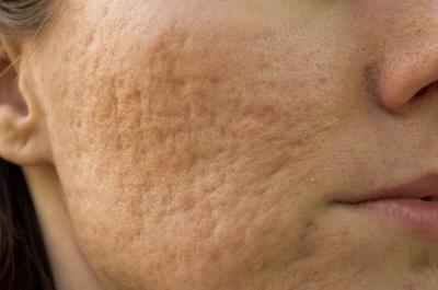 [skin concern] HUGE pores all over face : r/SkincareAddiction